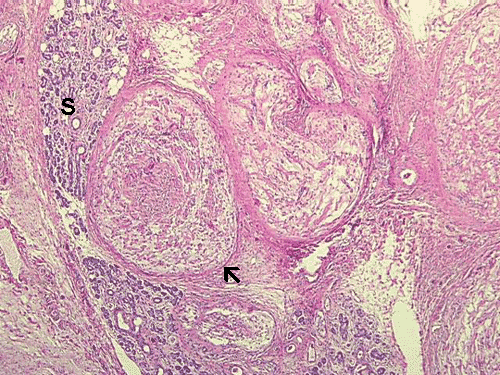 Plexiform Neurofibroma Histopathology