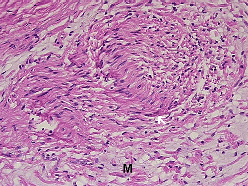 Plexiform Neurofibroma Histopathology