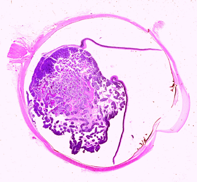 Retinoblastoma Drawing
