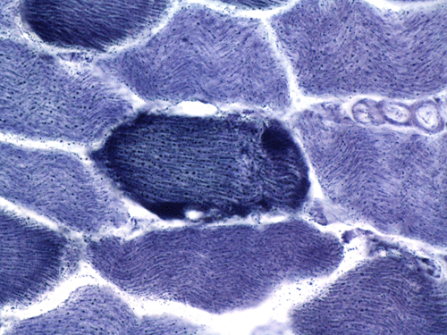 Mitochondrial Myopathy Ragged Red Fibers