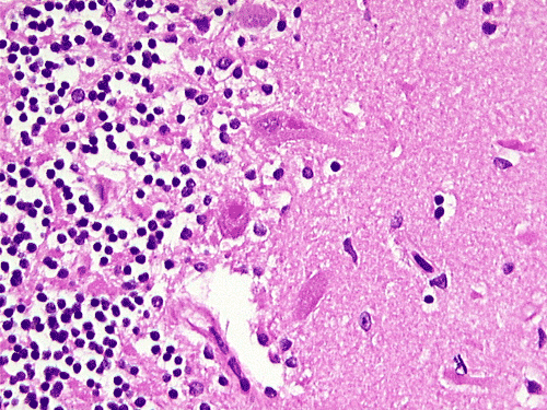 Negri Bodies Vs Lewy Body