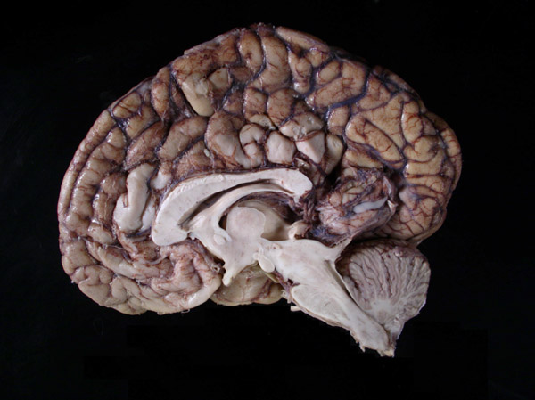Dandy Walker Malformation Gross